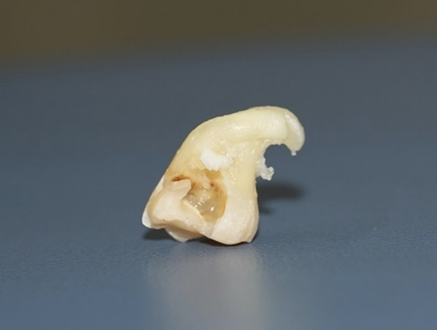 Vađenje umnjaka - operacija i oporavak - Poliklinika Krhen